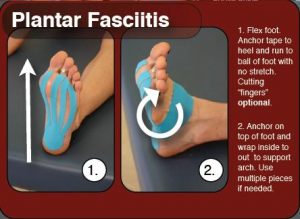 Plantar Fasciitis: Causes, Symptoms, Treatments + Best Shoes