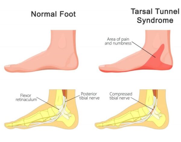Do Your Feet Go Numb When Running? 10 Solutions!